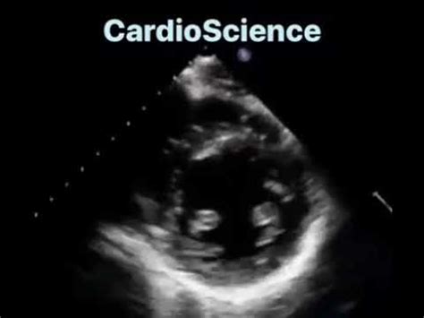 Ecocardiograma plano paraesternal eje corto a nivel músculos papilares
