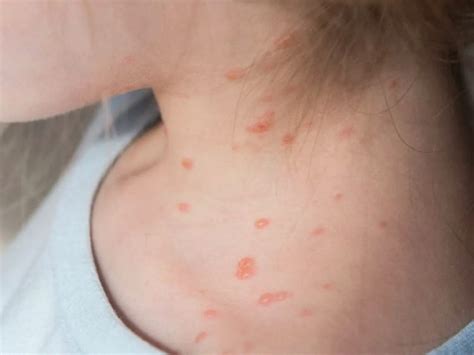 Come Si Prende Il Vaiolo Delle Scimmie Monkeypox Sintomi