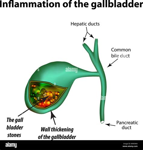 Gallstones Cholelithiasis Cholecystitis Inflammation Of The