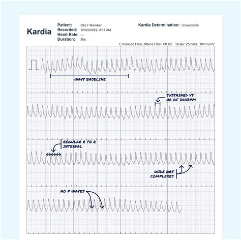 Sinus Tachycardia Vs Ventricular Tachycardia Sustained On Your Watch