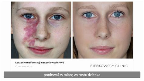 Usuwanie Zmian Naczyniowych Laser Cutera Excel V WIRTUALNA KLINIKA