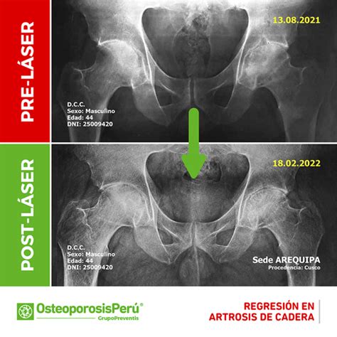 Regresi N En Artrosis De Cadera Rx Osteoporosis Per
