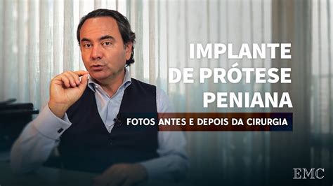 Pr Tese Peniana Fotos Antes E Depois Da Cirurgia Dr Paulo Egydio