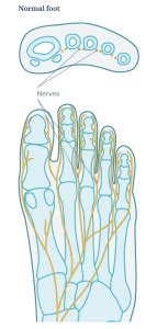 Mortons Neuroma Interdigital Neuroma Bursal Neuroma Complex