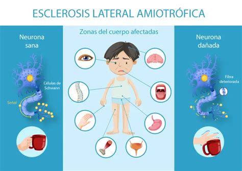 Todo sobre el ELA Esclerosis Lateral Amiotrófica VALIDA
