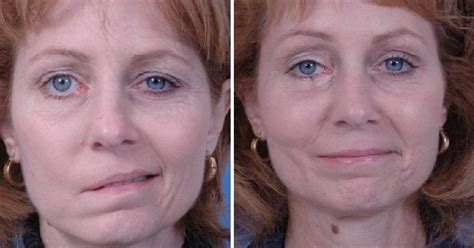 3 cosas que nunca debes hacer ante una parálisis facial el daño podría