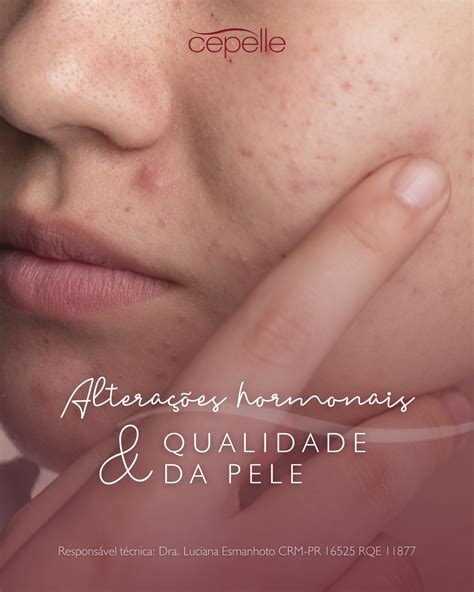 Alterações hormonais qualidade da pele Cepelle Dermatologia Curitiba