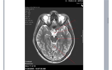 Brain Ct Scan Slice Diagram Quizlet