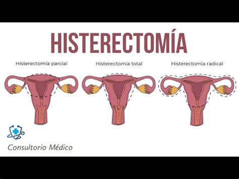 Histerectomía Tipos de histerectomía Por qué se hace una