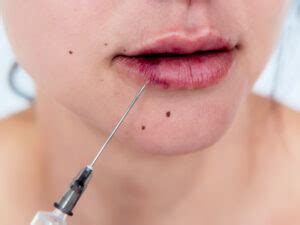 Preenchimento Labial Como é feito valor e resultados Dream
