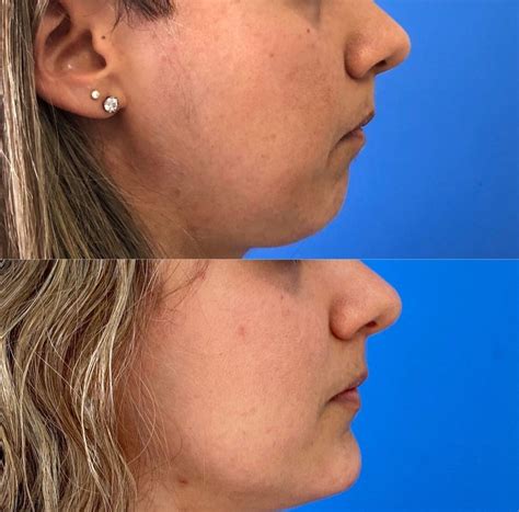 Mentoplastia Antes y después Esteticas ar Esteticas ar