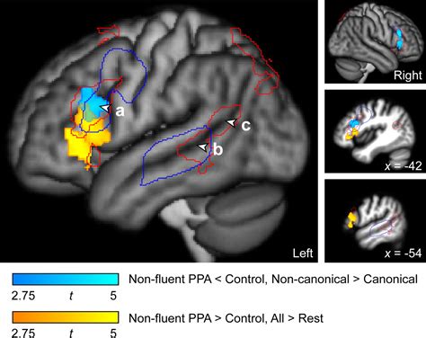 neural correlates of syntactic processing in the nonfluent variant of primary progressive
