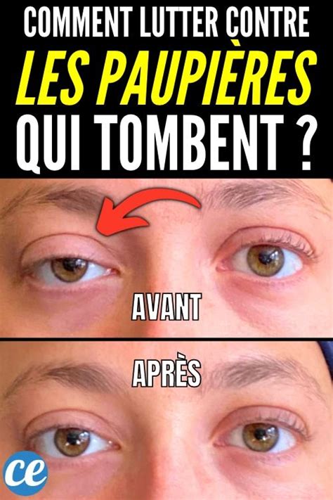 La Ptose Ou L Affaissement De La Paupi Re Sup Rieure Est Une