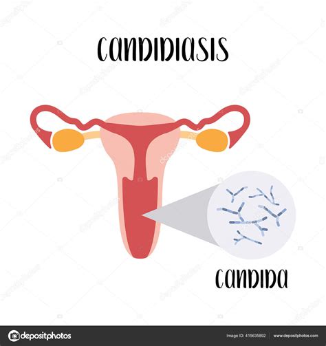 Candidiasis Cándida Enfermedad Vaginal Bacteriana Sistema Reproductivo