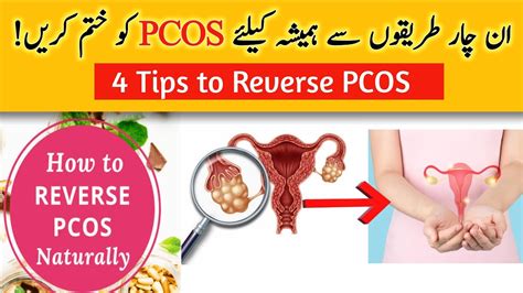 Tips To Reverse Pcos Naturally How To Cure Pcos Naturally At Home