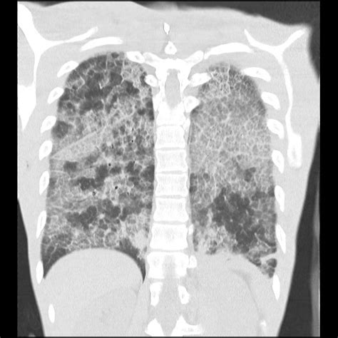 Pulmonary Alveolar Proteinosis Image Radiopaedia Org