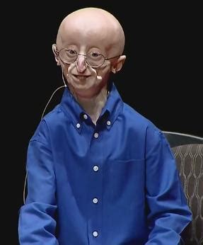 Cos è la progeria e quali sono i casi famosi nel mondo