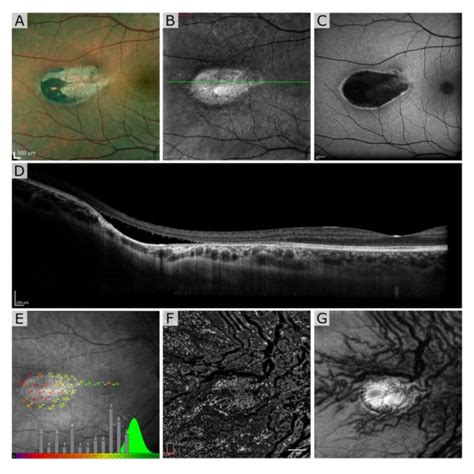 Patient 1 Imaged With Multimodal Clinical Imaging A Fundus Images