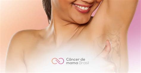 Linfonodo Sentinela Positivo Câncer de Mama Brasil