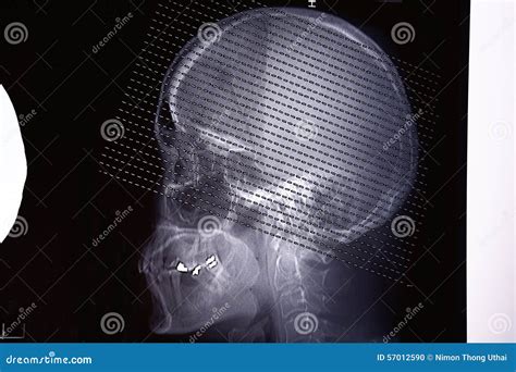 Computerized Film X Ray Tomography Of Human Brain CT Scan Royalty Free
