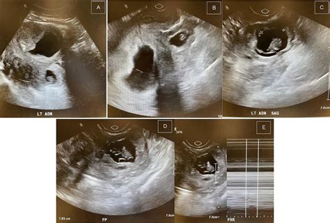 9 Week Ectopic Pregnancy Ultrasound