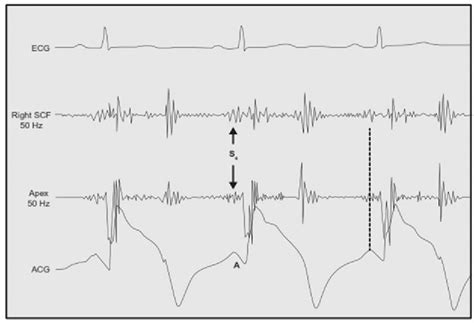 Figure 1 From Additional Heart SoundsPart 1 Third And Fourth Heart