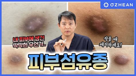 혹처럼 뭉쳐있는 피부 섬유종 내 피부 안에 뭔가 만져진다면 YouTube