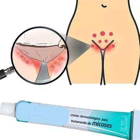 Micose Na Virilha Pomada Para Micose Na Virilha MercadoLivre