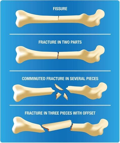 Fracture Recognition And Treatment Options Orthopedic Center For