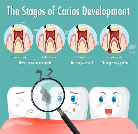 Infographic Of Human In Stages Of Caries Development Vector The Best
