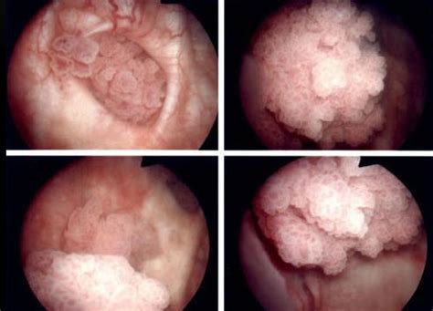 Bladder Cancer Medlibes Online Medical Library