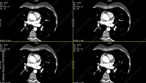 Axial Contrast Of The Cardio System With Radiology A Computerized