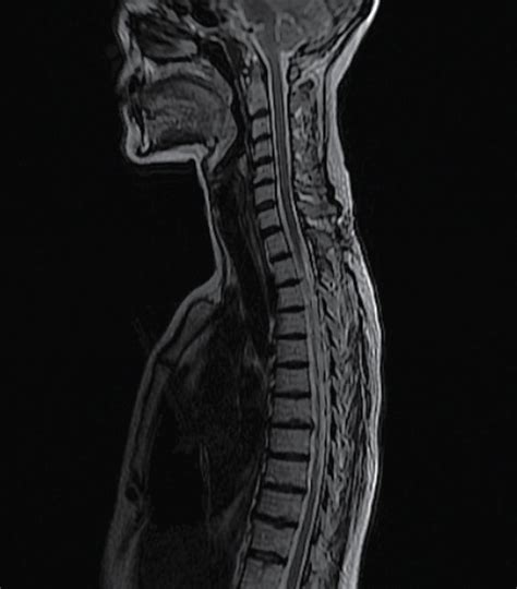 Sagittal T2 Weighted Magnetic Resonance Imaging Of The Thoracic Spine