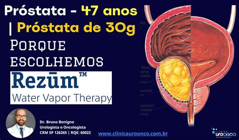 Revolucionando o Tratamento da Próstata Como a Terapia Vapor de
