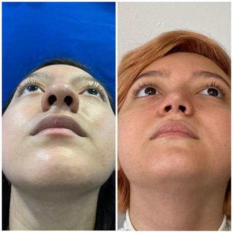 Cirug A Pl Stica Guatemala Dr Salvador Recinos Rinoplastia