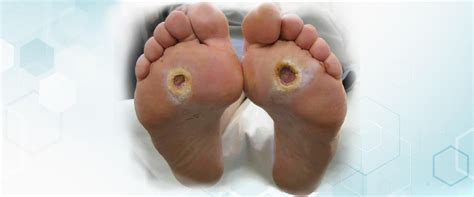 Arterial Ulcer
