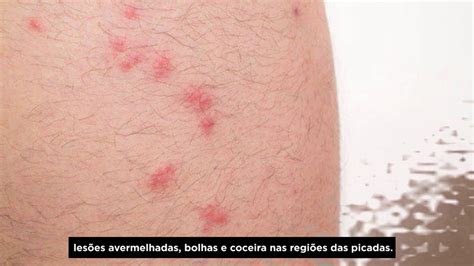 Picada De Insetos YouTube