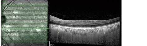Enhanced Depth Imaging Spectral Domain Optical Coherence Tomography