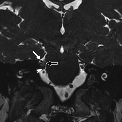 MRI Of The Trigeminal Nerve In Patients With Trigeminal Neuralgia