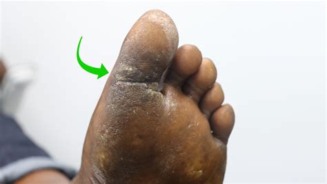 Removing THE WORST Ingrown Toenail Ever