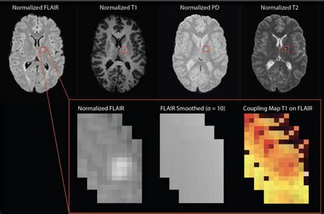 detecting multiple sclerosis lesions via intermodal coupling analysis cceb
