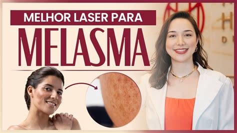 Qual é o melhor laser para CLAREAR MANCHAS DE MELASMA YouTube