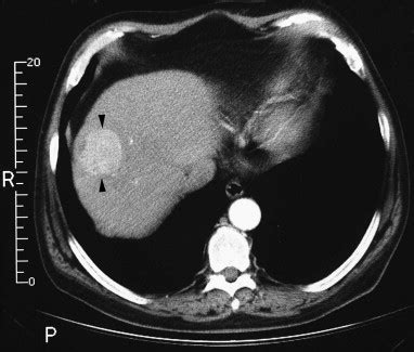 Malignant Tumours Of The Liver Surgery Oxford International Edition