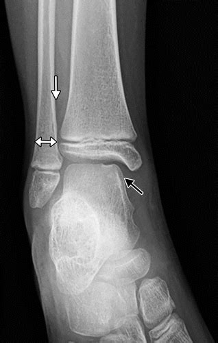 Normal Left Ankle Xray