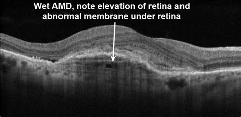 Focus On Wet Age Related Macular Degeneration