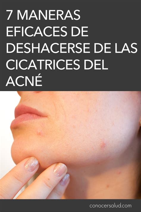 Maneras Eficaces De Deshacerse De Las Cicatrices Del Acn