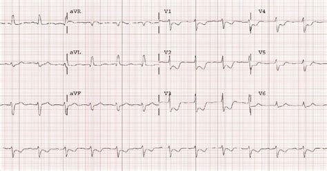Study Medical Photos Acute Posterior Myocardial Infarction ECG