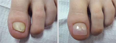 Before After KeryFlex Nail Restoration System