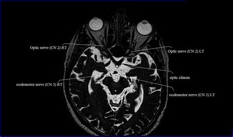 Cranial Nerves Axial Mri