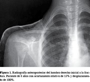 Acortamiento relativo de clavícula en fracturas pediátricas Su